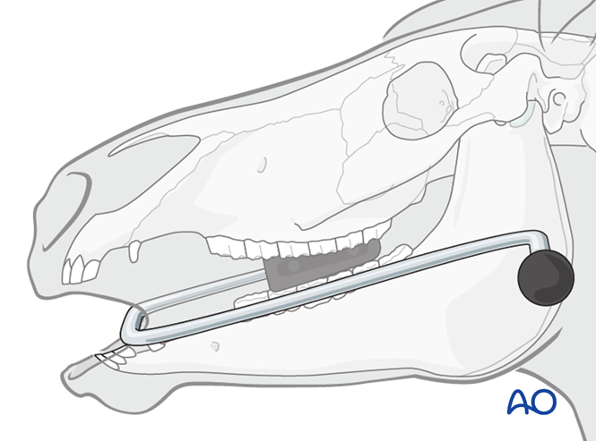 U-shaped splint for Horizontal ramus/interdental space: Bilateral fractures