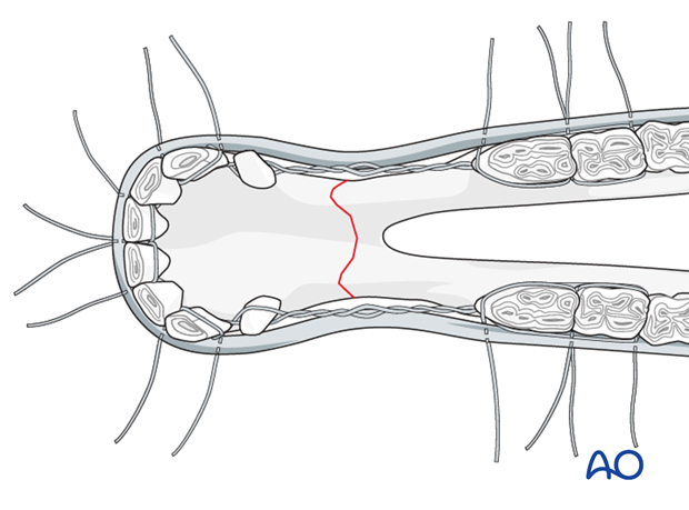 U-shaped splint for Horizontal ramus/interdental space: Bilateral fractures