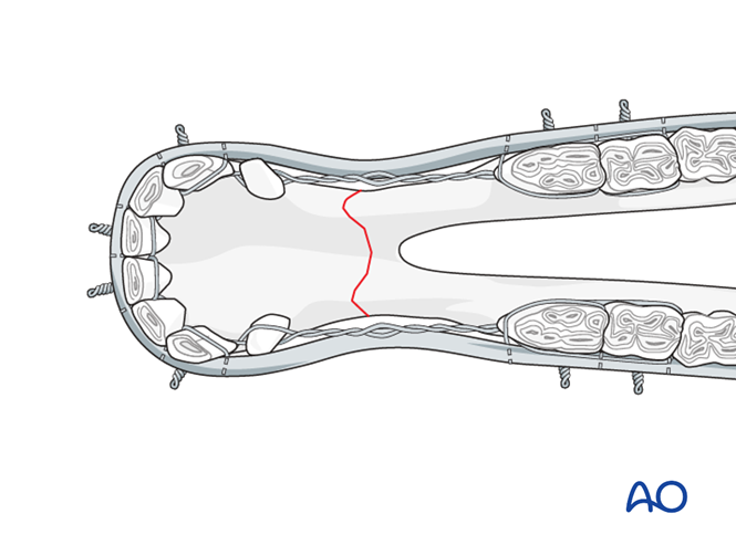 U-shaped splint for Horizontal ramus/interdental space: Bilateral fractures