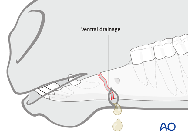 U-shaped splint for Horizontal ramus/interdental space: Bilateral fractures