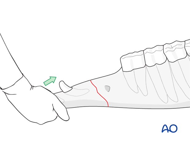 U-shaped splint for Horizontal ramus/interdental space: Bilateral fractures