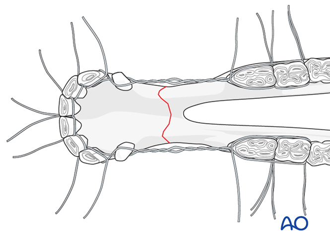 U-shaped splint for Horizontal ramus/interdental space: Bilateral fractures