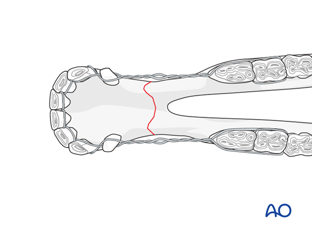 U-shaped splint for Horizontal ramus/interdental space: Bilateral fractures