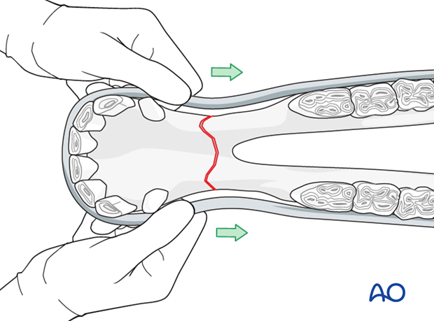 U-shaped splint for Horizontal ramus/interdental space: Bilateral fractures
