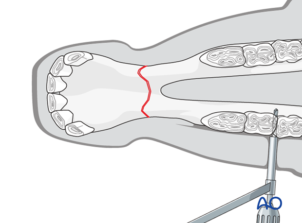 U-shaped splint for Horizontal ramus/interdental space: Bilateral fractures