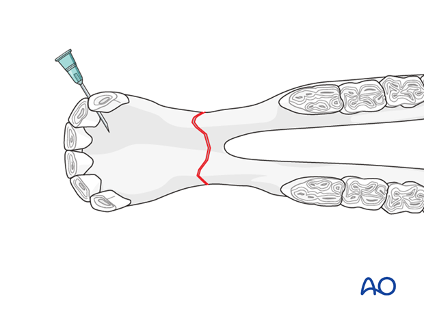 U-shaped splint for Horizontal ramus/interdental space: Bilateral fractures