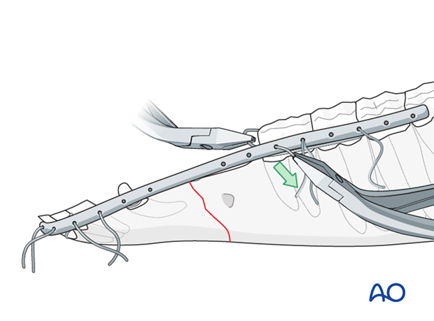 U-shaped splint for Horizontal ramus/interdental space: Bilateral fractures