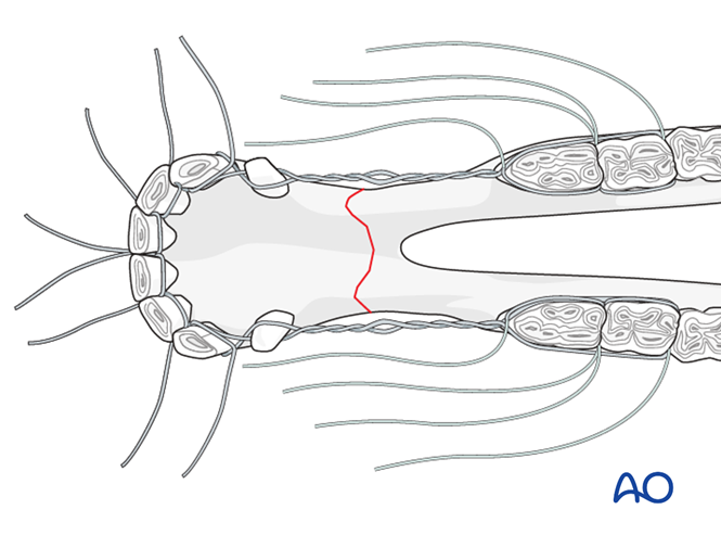 U-shaped splint for Horizontal ramus/interdental space: Bilateral fractures