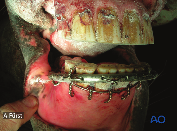 U-shaped splint for Horizontal ramus/interdental space: Bilateral fractures
