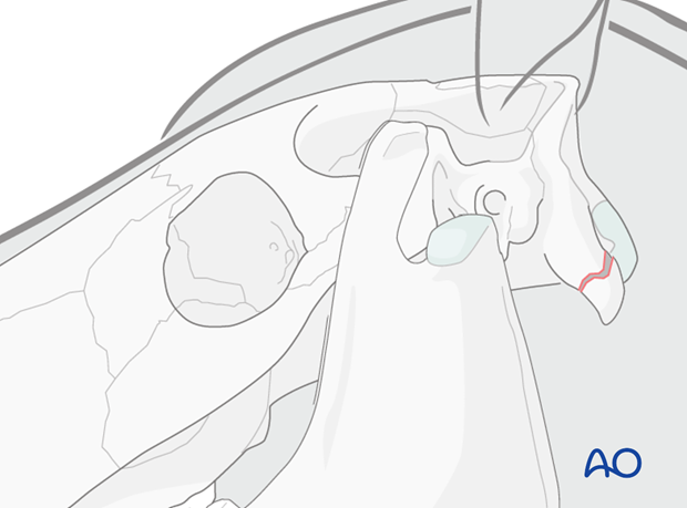 Fracture of the paracondylar process