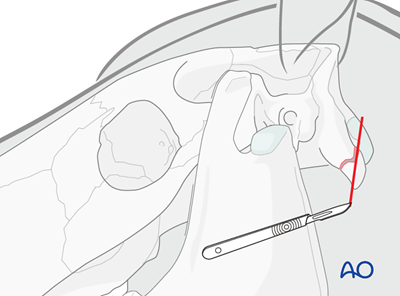 Resection for Fractures of the paracondylar process