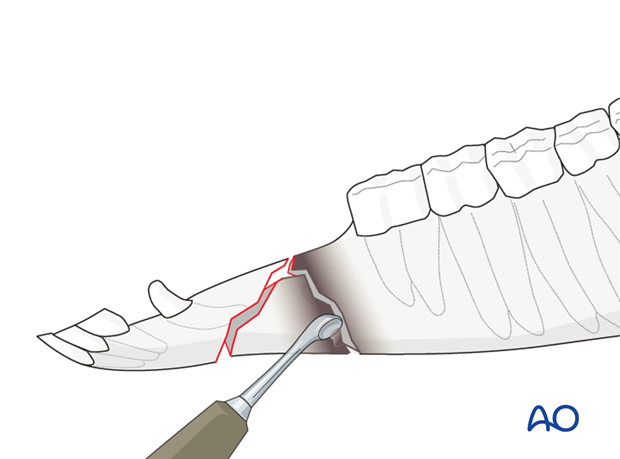 Fixation using PMMA compounds for Horizontal ramus/interdental space ...