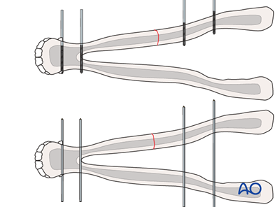 External fixator for Horizontal ramus/interdental space: Bilateral ...