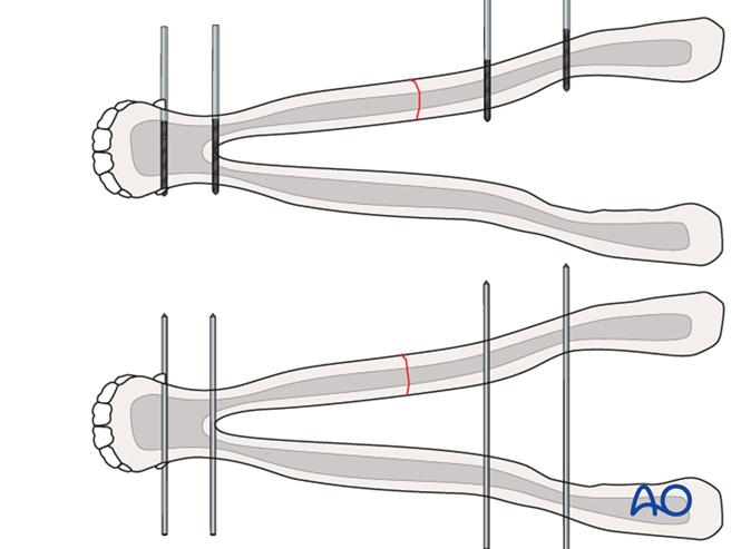 External fixator for Horizontal ramus/interdental space: Bilateral ...