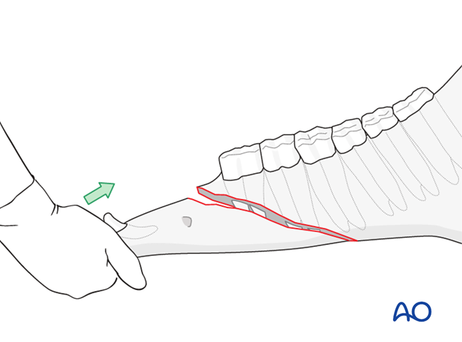 External fixator for Horizontal ramus/interdental space: Bilateral ...