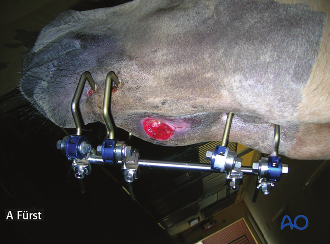 Pinless external fixator for Horizontal ramus/interdental space ...