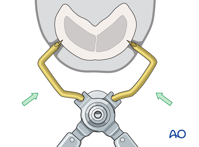 Stab incisions: external fixator