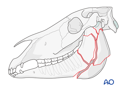 Fractures of the vertical ramus