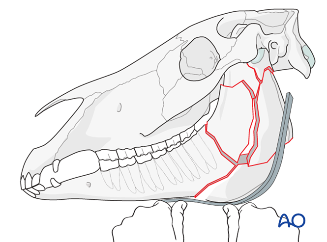 Plate fixation for Fractures of the vertical ramus