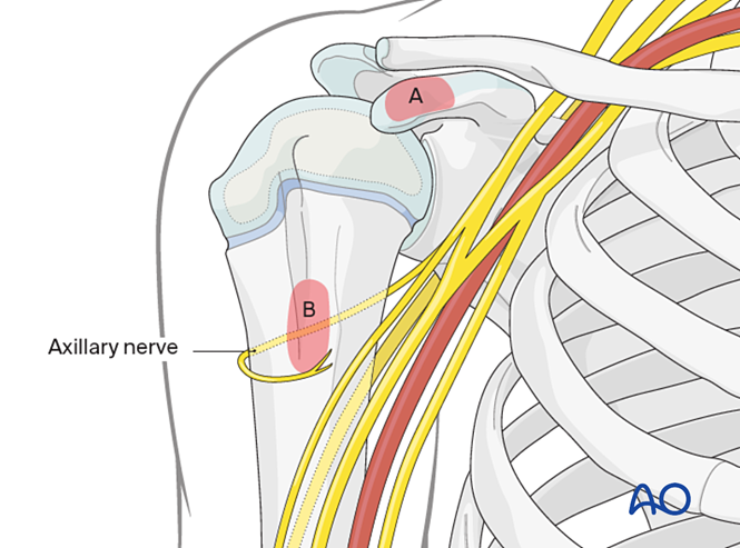 Deltopectoral interval approach to the proximal humerus