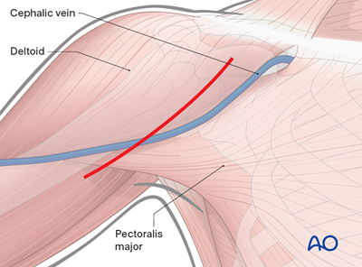 Deltopectoral interval approach to the proximal humerus