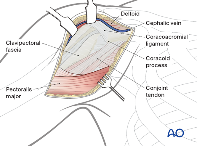 Deltopectoral interval approach to the proximal humerus