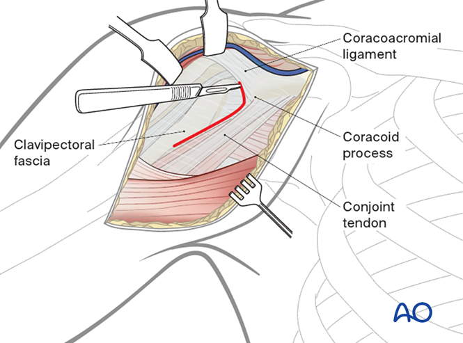 Deltopectoral interval approach to the proximal humerus