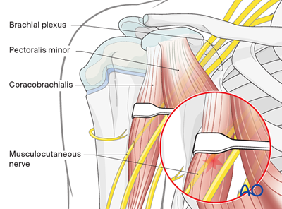 Deltopectoral interval approach to the proximal humerus