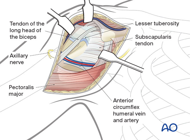 Deltopectoral interval approach to the proximal humerus