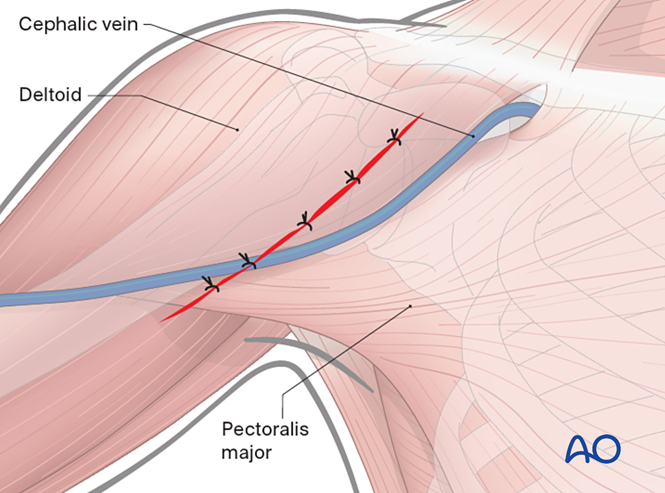 Deltopectoral interval approach to the proximal humerus