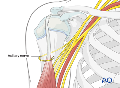 Anterolateral approach to the proximal humerus