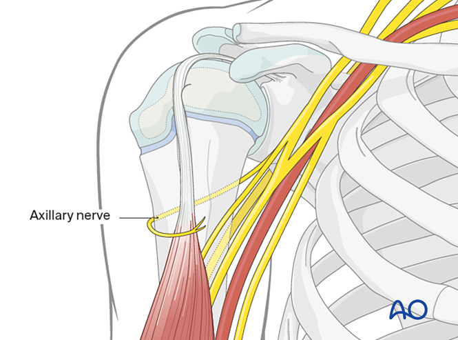 Anterolateral approach to the proximal humerus