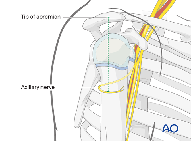 Lateral approach with deltoid splitting