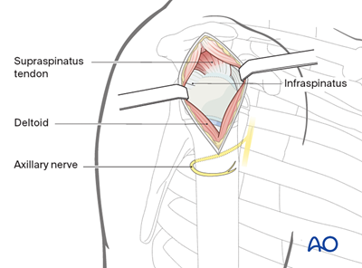 Lateral approach with deltoid splitting