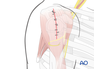 Lateral approach with deltoid splitting