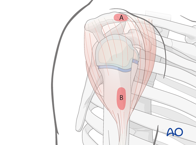 Anterolateral approach to the proximal humerus