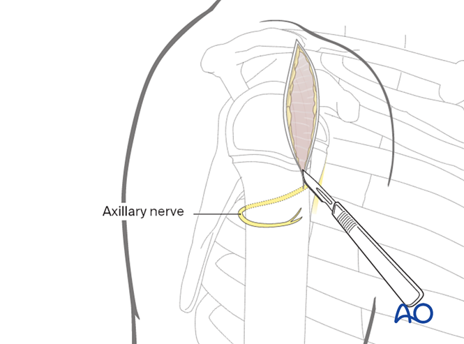 Anterolateral approach to the proximal humerus