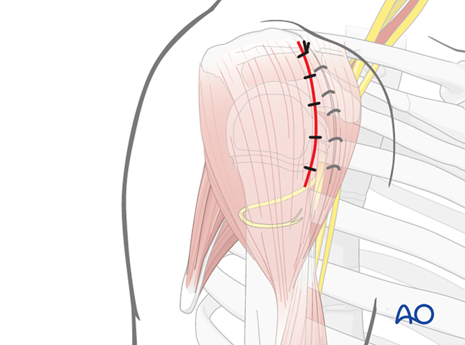 Anterolateral approach to the proximal humerus