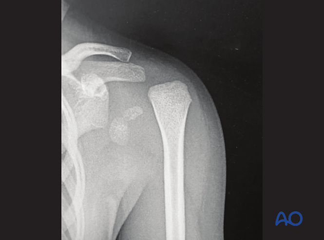 Epiphysiolysis with/without metaphyseal wedge (Salter-Harris I and II)