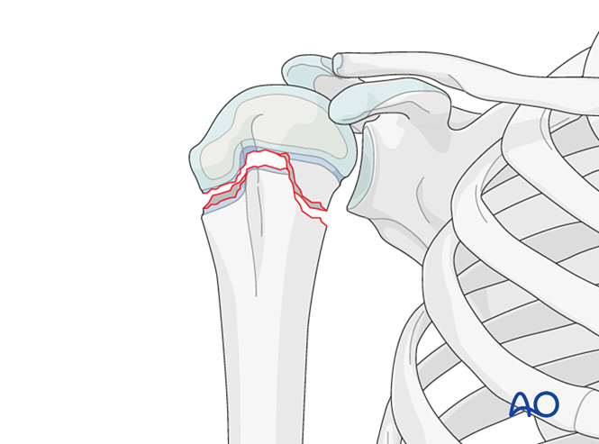 Epiphysiolysis with/without metaphyseal wedge (Salter-Harris I and II)