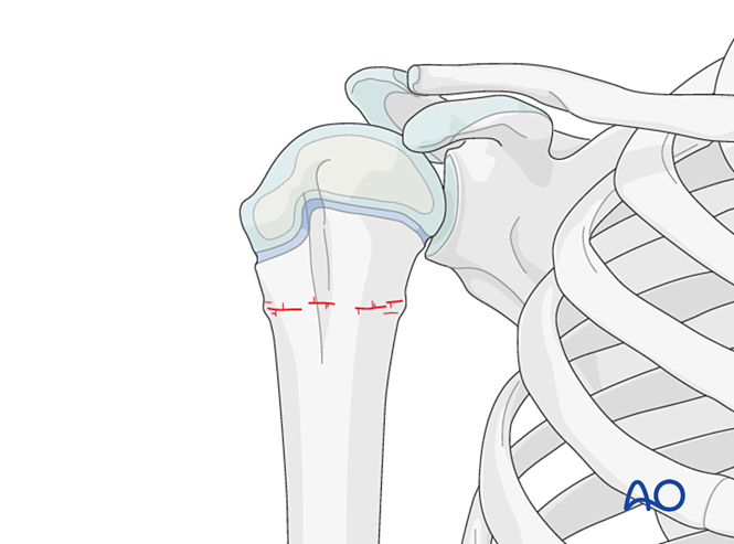 Torus/buckle and greenstick fracture