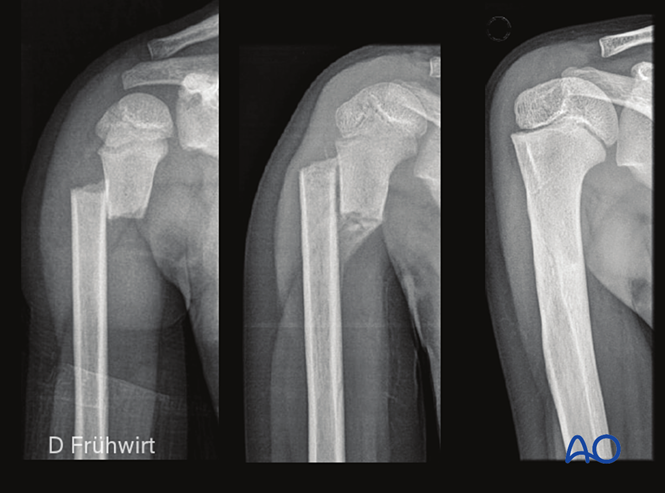Simple complete metaphyseal fracture