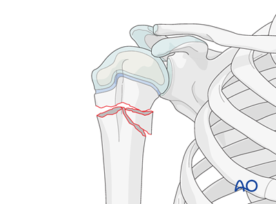 Multifragmentary complete metaphyseal fracture