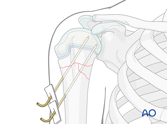 K-wire fixation for Multifragmentary complete metaphyseal fracture