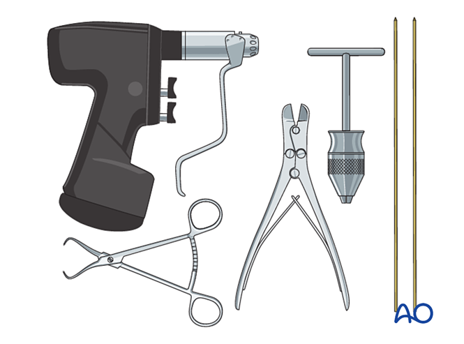 K-wire fixation for Simple complete metaphyseal fracture