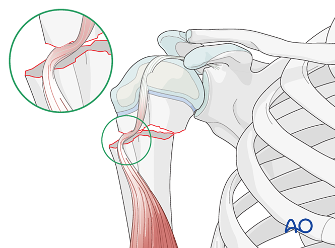 K-wire fixation for Simple complete metaphyseal fracture