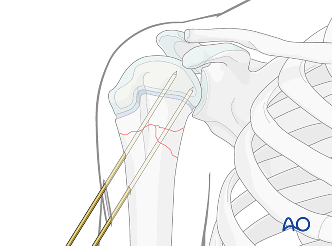 K-wire fixation for Multifragmentary complete metaphyseal fracture