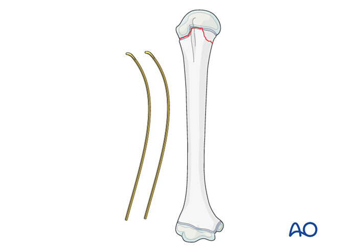 Elastic nailing for Epiphysiolysis with/without metaphyseal wedge ...