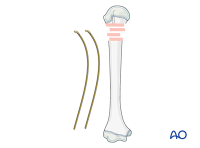 Elastic nailing for Simple complete metaphyseal fracture