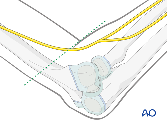 Elastic nailing for Simple complete metaphyseal fracture